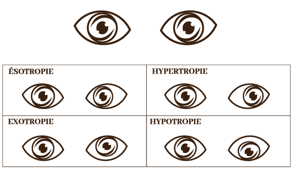 Strabisme » Centre Vision Cébazat